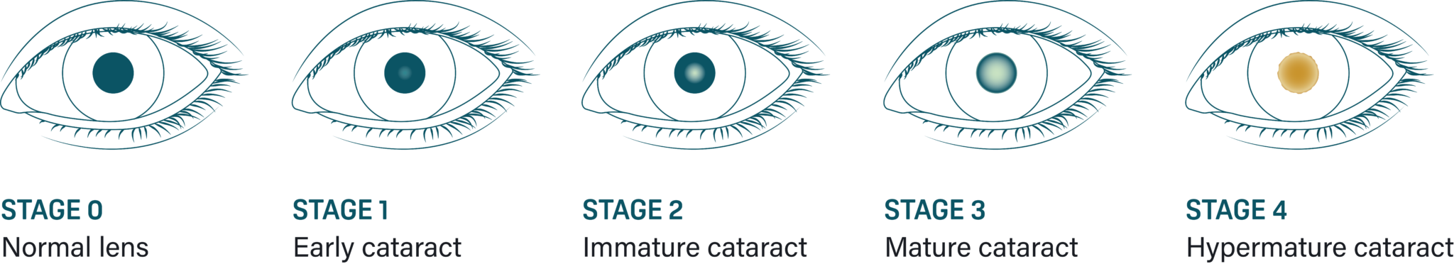 Cataracts – PVSC