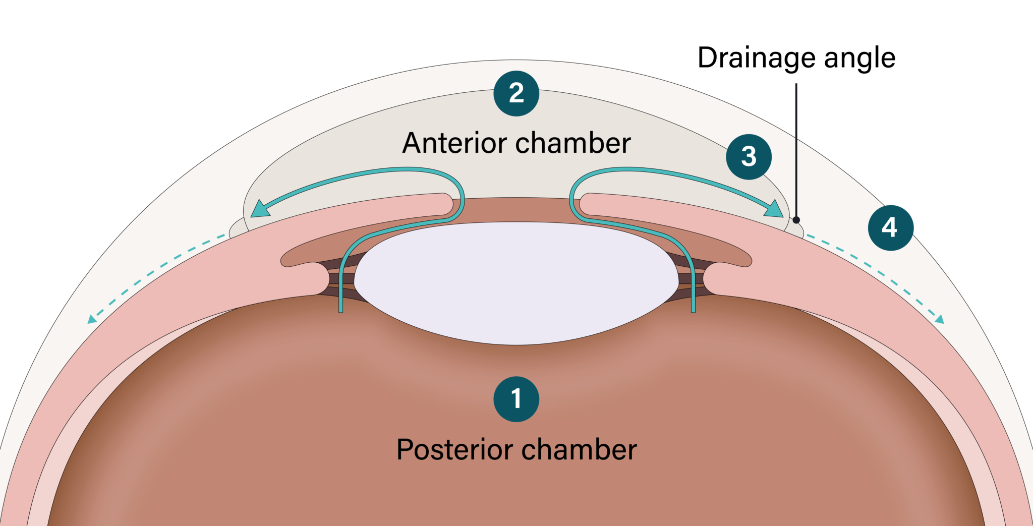 Glaucoma – PVSC
